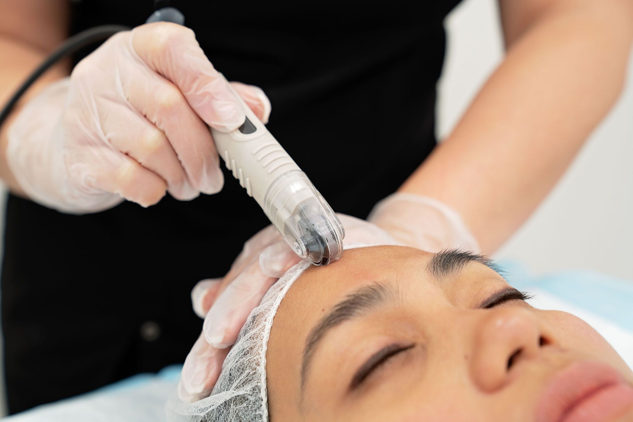 Skin Infusion SILK’s intro treatment into Microneedling