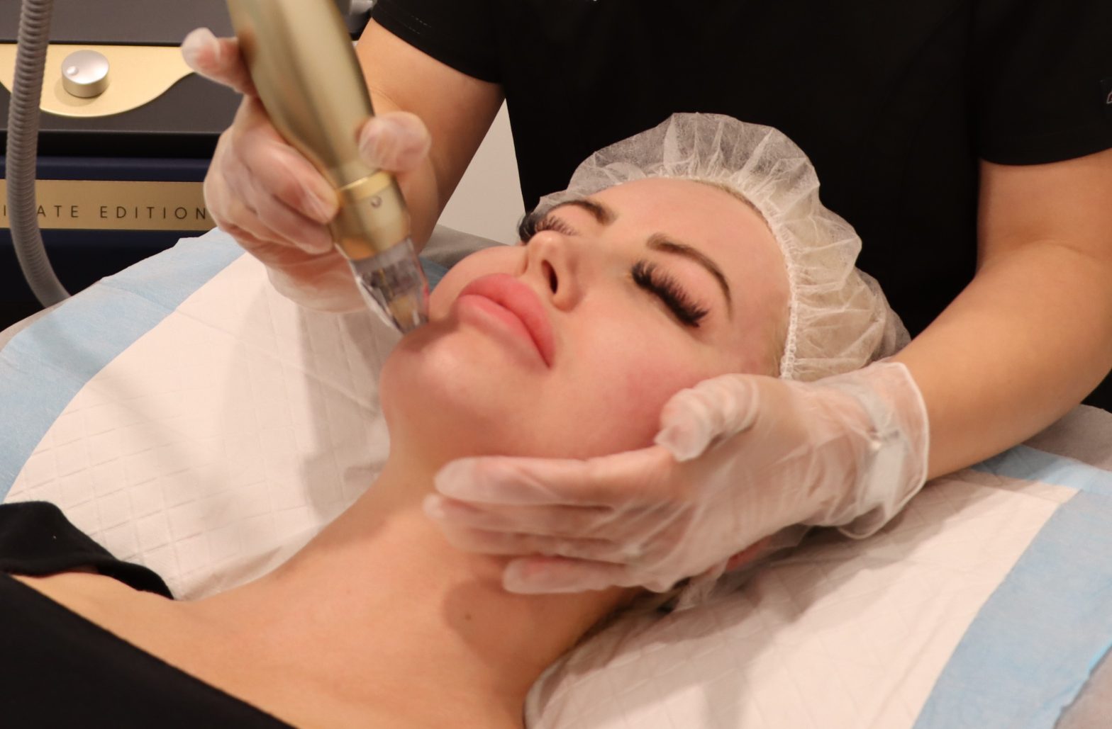 Sylfirm X™ Advanced RF Needling - SILK Laser Clinics