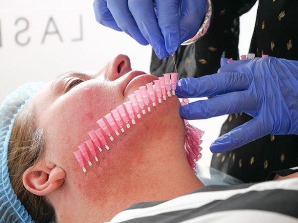 PDO Mono Threads Treatment - SILK Laser Clinics