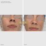 Lumixa Skin Treatment & Normaliser - SILK Laser Clinics