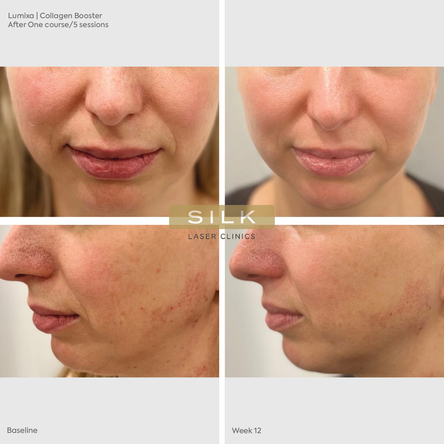 Lumixa Skin Treatment & Normaliser - SILK Laser Clinics