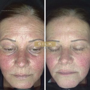 Lumixa Skin Treatment & Normaliser - SILK Laser Clinics
