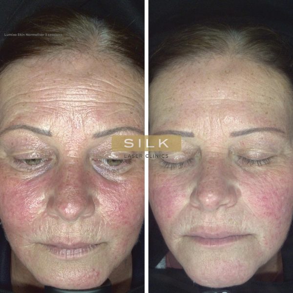 Lumixa Skin Treatment & Normaliser - SILK Laser Clinics