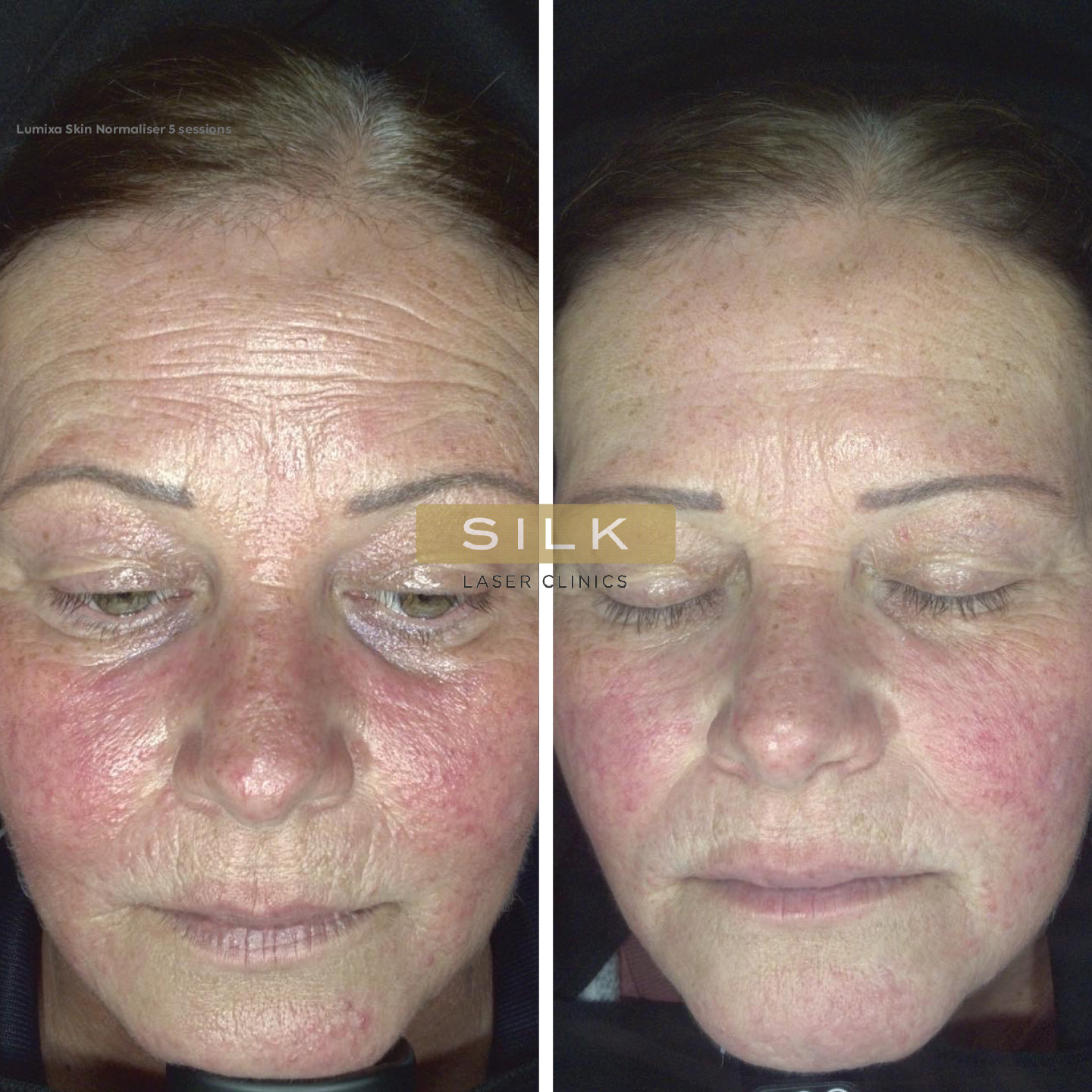 Lumixa Skin Treatment & Normaliser - SILK Laser Clinics