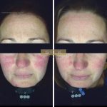 Lumixa Skin Treatment & Normaliser - SILK Laser Clinics