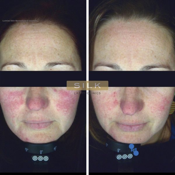 Lumixa Skin Treatment & Normaliser - SILK Laser Clinics